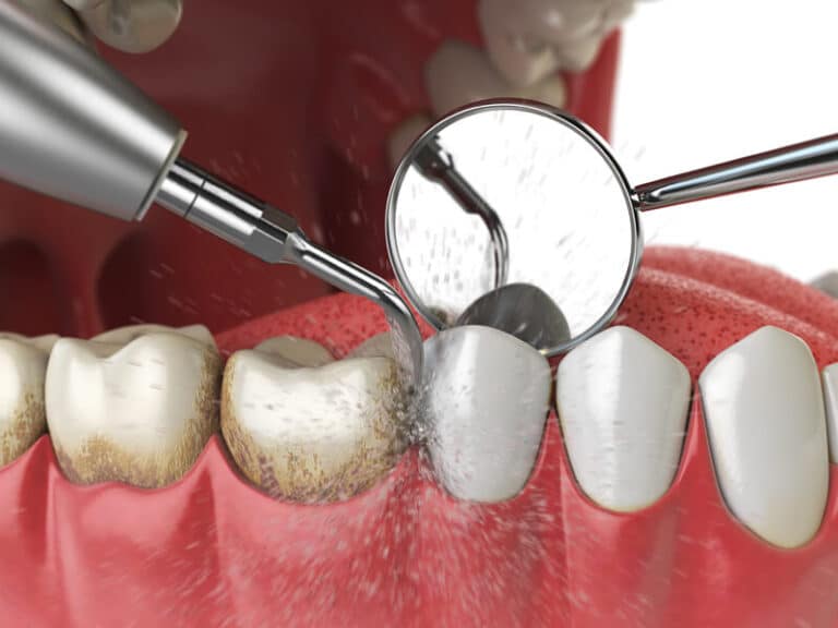 Cuci Gigi / Scaling | Klinik Pergigian Asma